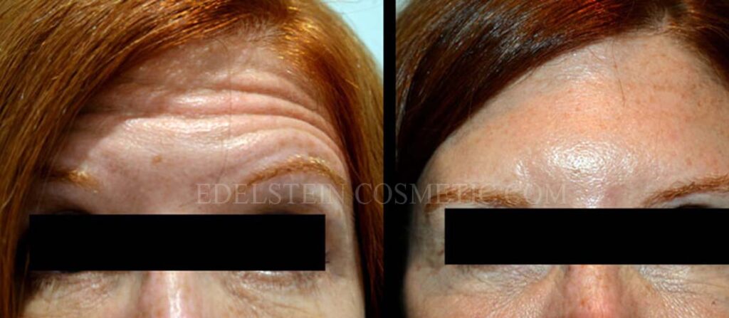 BOTOX & Wrinkle Relaxers In Toronto | Edelstein Cosmetics